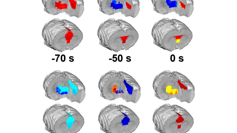 Brain mechanisms underpinning loss of consciousness identified | Penn ...