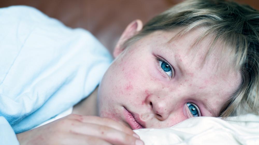 The Medical Minute: Immunization the best defense against measles ...