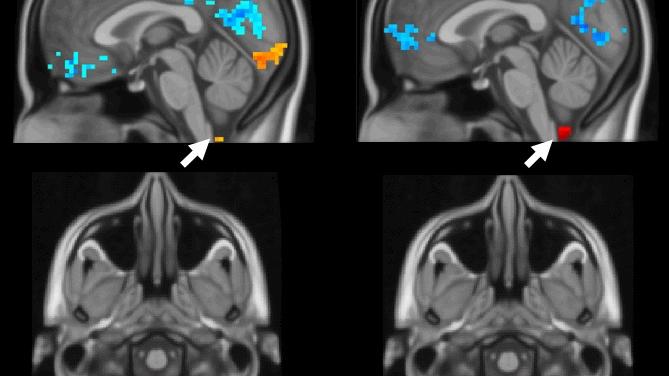 Coupled brain activity, cerebrospinal fluid flow could indicate ...