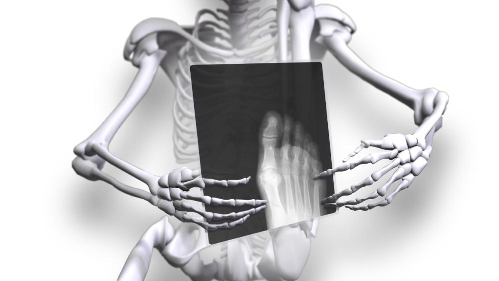 Common gene variants linked to delayed healing of bone fractures | Penn ...